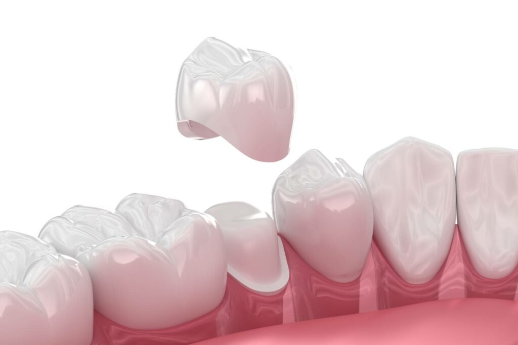 Porcelain Crowns - Sugarloaf Signature Dentistry